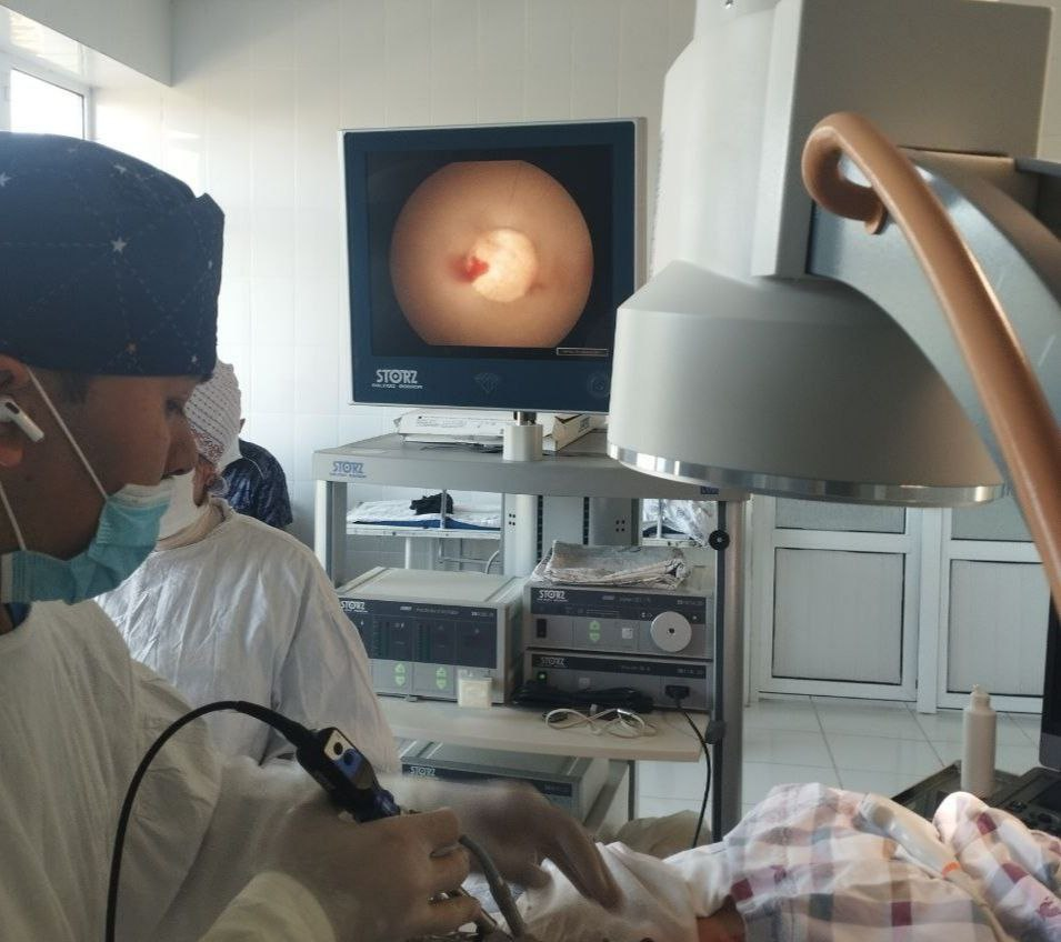 Ikki yoshli bola buyragidagi toshlar noyob lazerli enduorologik ...